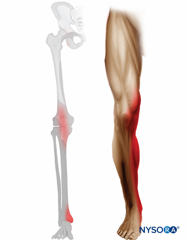 Ultrasound-Guided Saphenous (Adductor Canal) Nerve Block - NYSORA