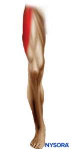 Ultrasound-Guided Lateral Femoral Cutaneous Nerve Block - NYSORA