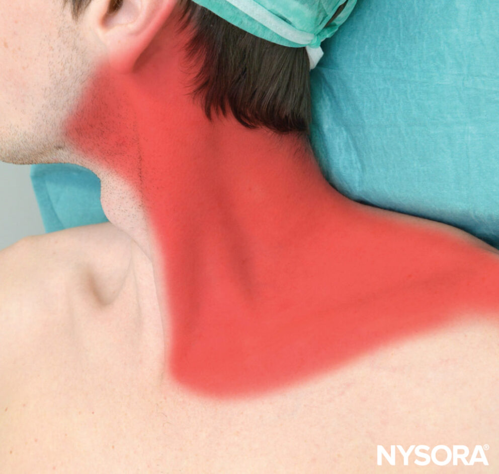 Ultrasound-Guided Cervical Plexus Nerve Block - NYSORA