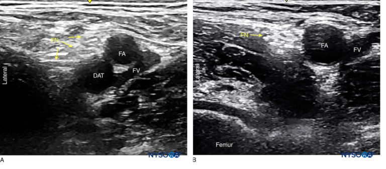 Ultrasound-Guided Femoral Nerve Block - NYSORA