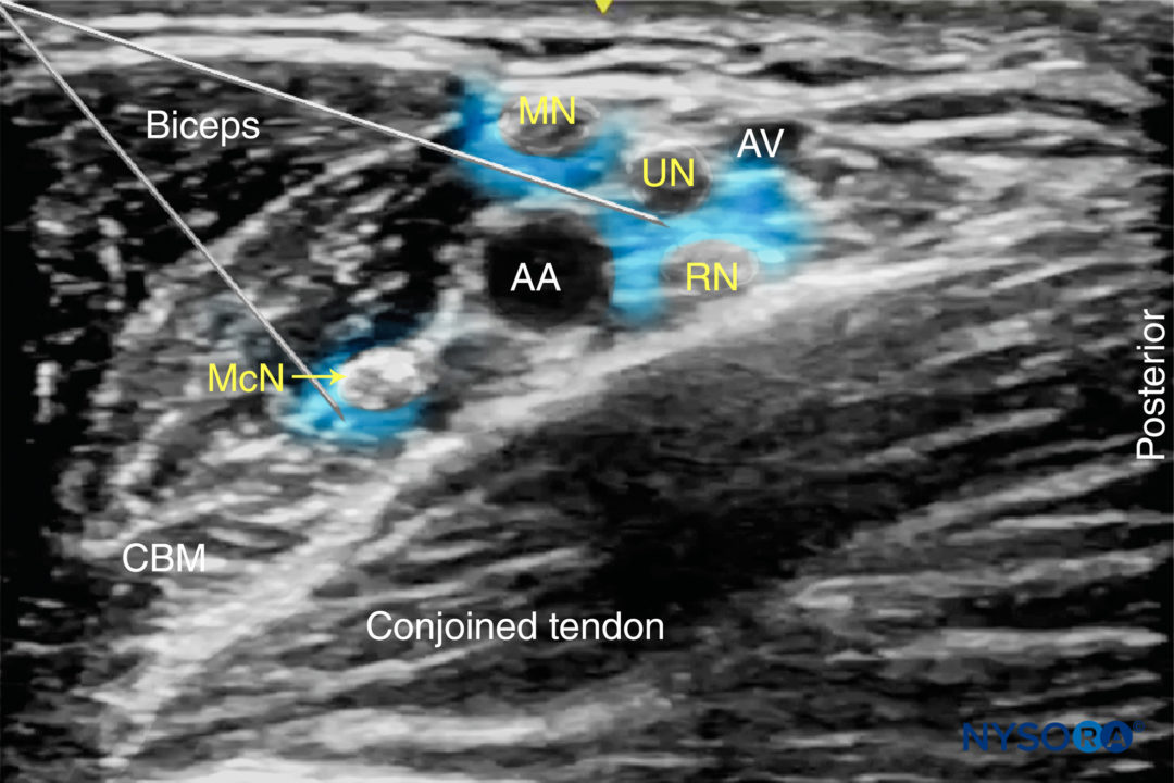 Ultrasound-Guided Axillary Brachial Plexus Block - NYSORA