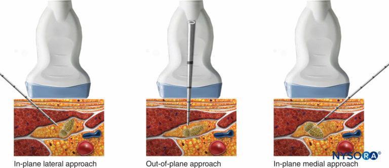 Ultrasound-Guided Popliteal Sciatic Nerve Block - NYSORA