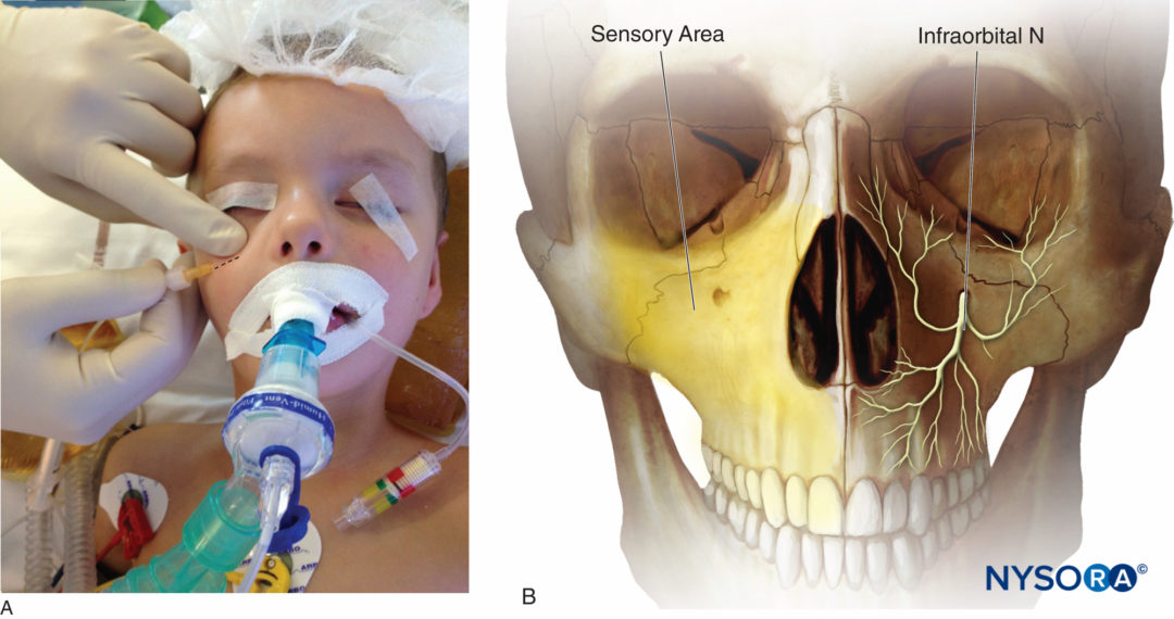 regional-anesthesia-infraorbital-nerve-block-and-sensory-area-of-the ...