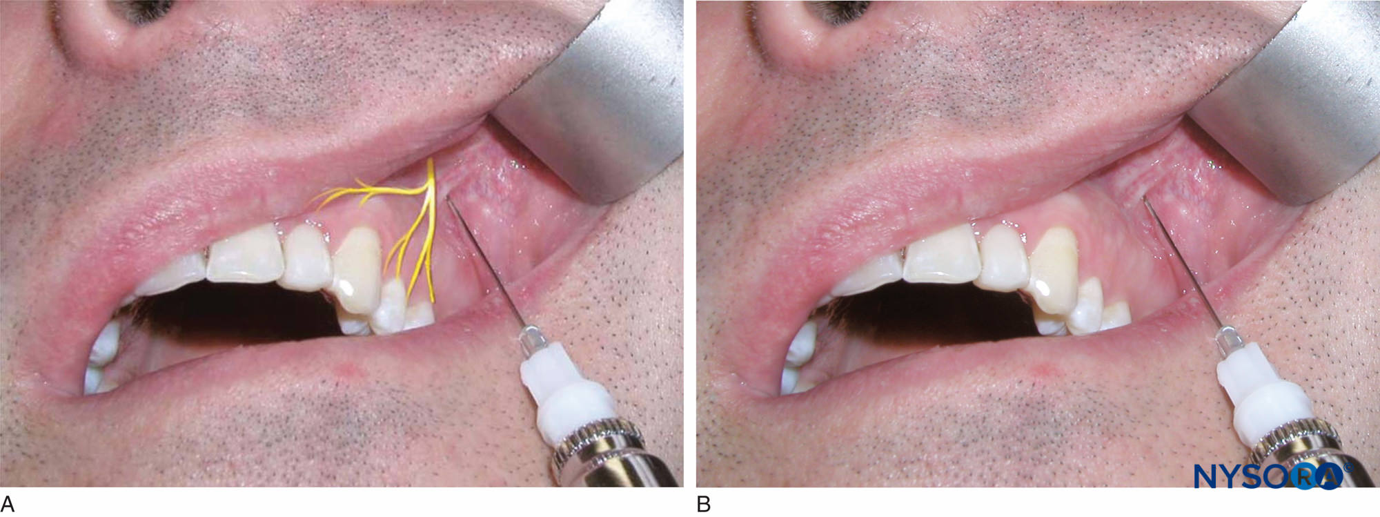 regional-anesthesia-location-of-the-middle-superior-alveolar-nerve-and ...