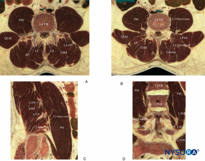 Cadaver Do Musculo Psoas Maior