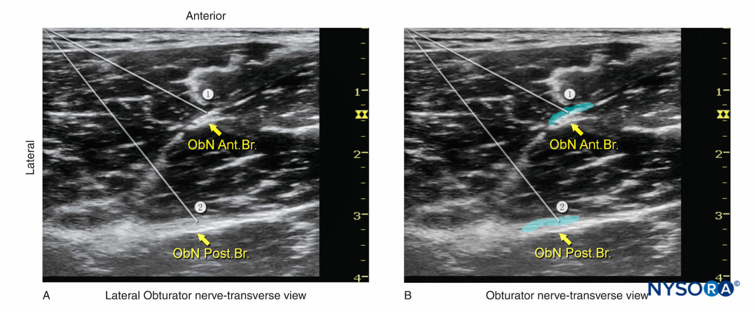 Ultrasound-Guided Obturator Nerve Block - NYSORA