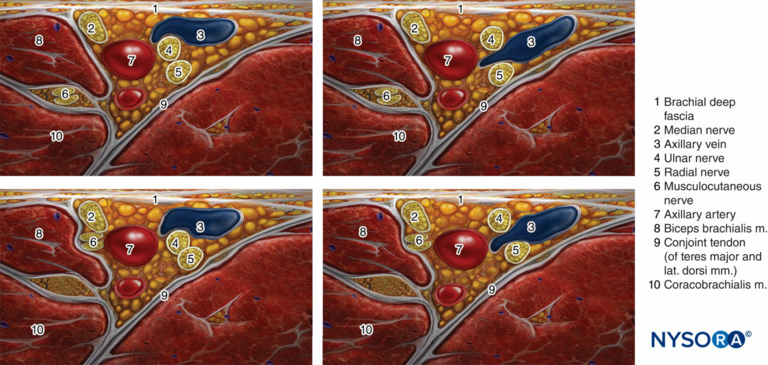 Ultrasound-Guided Axillary Brachial Plexus Block - NYSORA