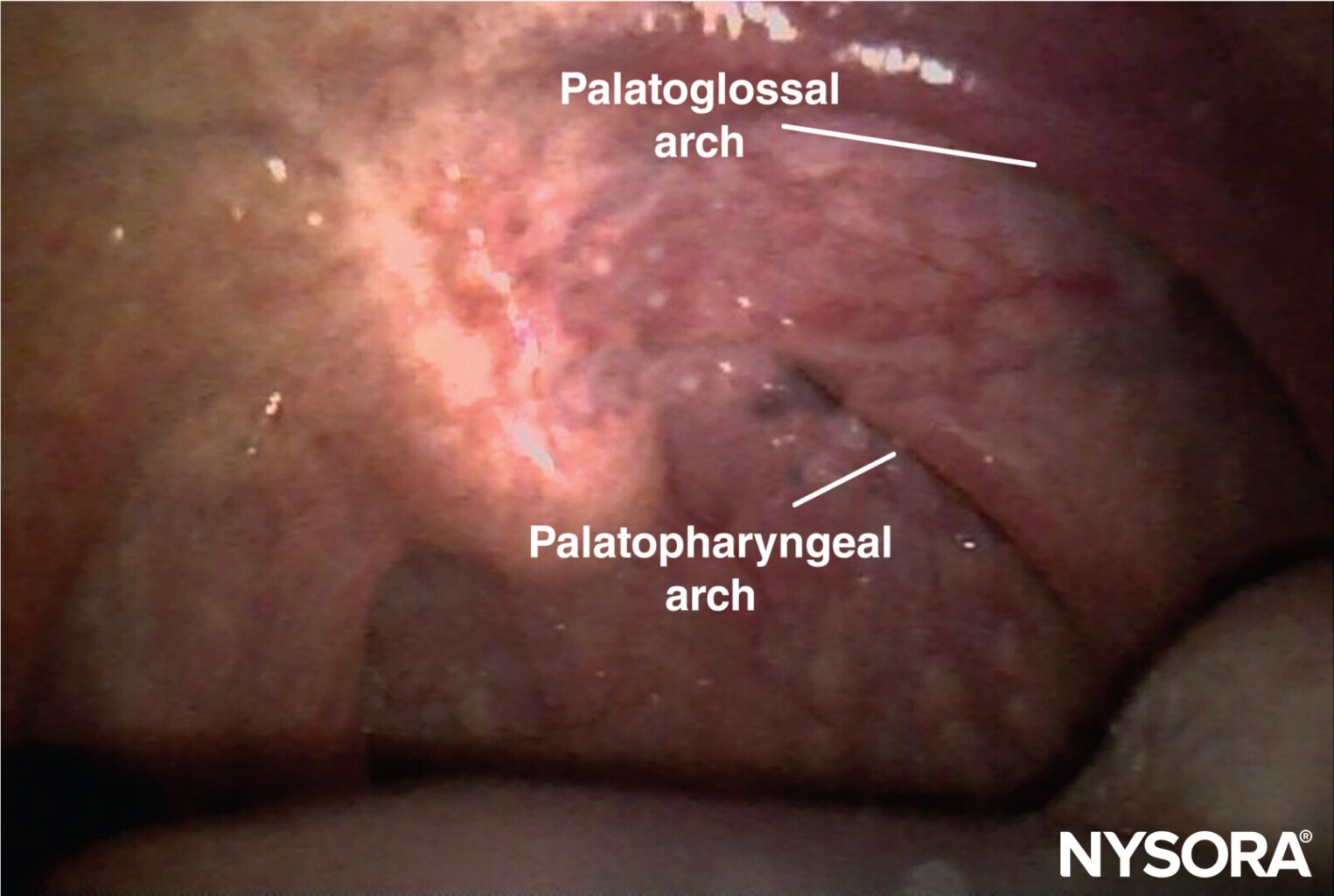 Regional and Topical Anesthesia for Awake Endotracheal Intubation - NYSORA