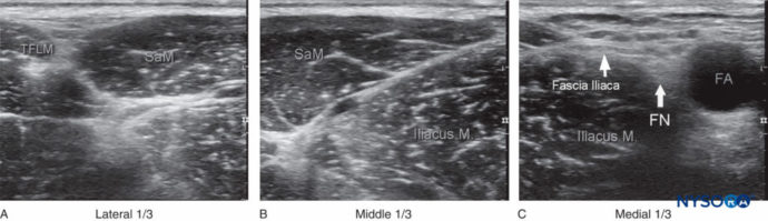 Ultrasound-Guided Fascia Iliaca Nerve Block - NYSORA