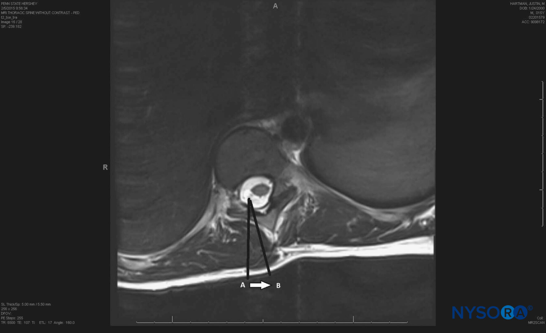 Neuraxial Anatomy - NYSORA