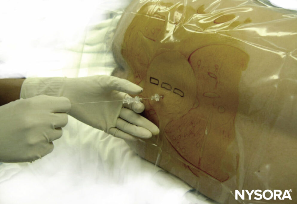 Spinal Anesthesia - NYSORA