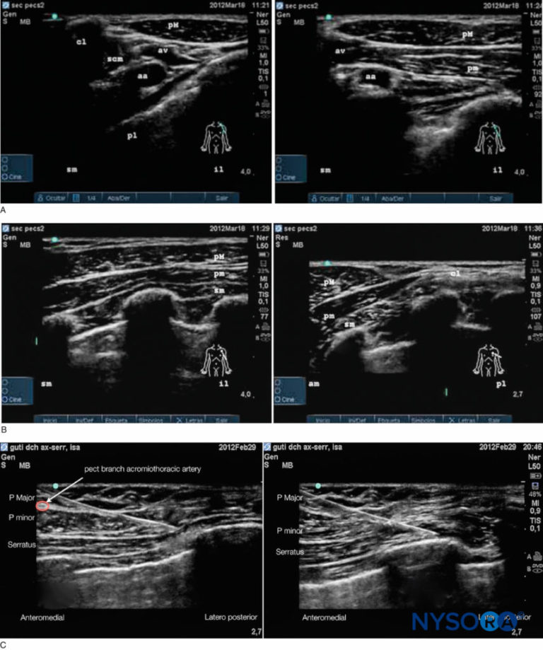 Pectoralis and Serratus Plane Nerve Blocks - NYSORA