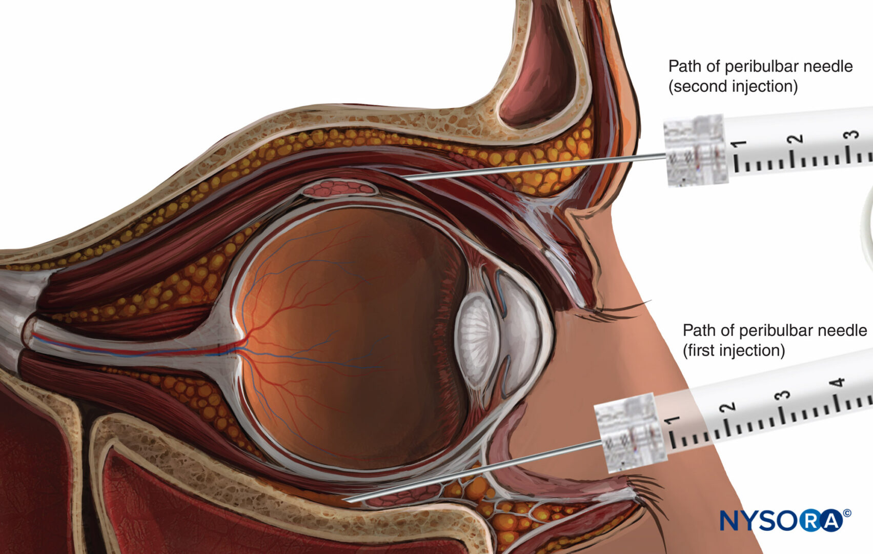 Regional Anesthesia Peribulbar Nerve Block Superior Second Injection