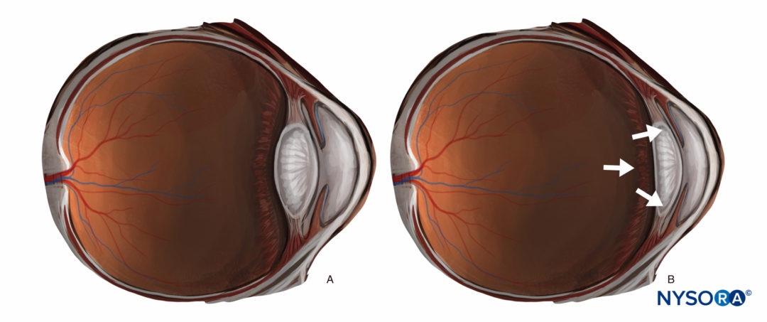Local and Regional Anesthesia for Ophthalmic Surgery - NYSORA