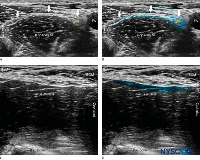 Bloc du nerf fascia iliaque guidé par ultrasons - NYSORA
