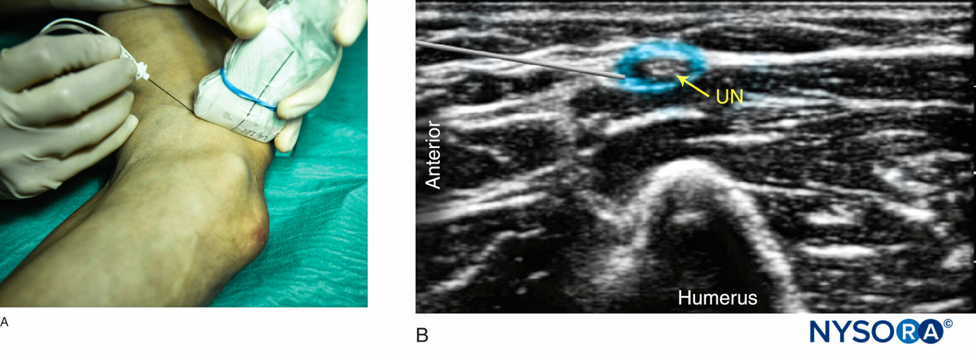 Regional Anesthesia Position Of Arm Probe And Needle For Ulnar Nerve Block Proximal To Elbow