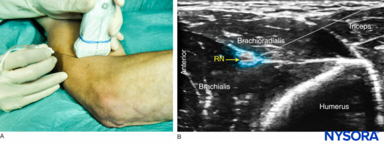 Ultrasound-Guided Blocks at the Elbow - NYSORA