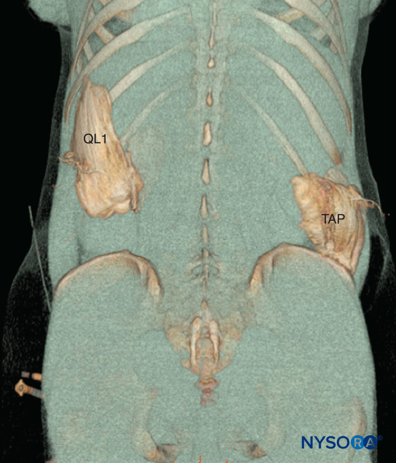 Ultrasound-Guided Transversus Abdominis Plane and Quadratus Lumborum ...
