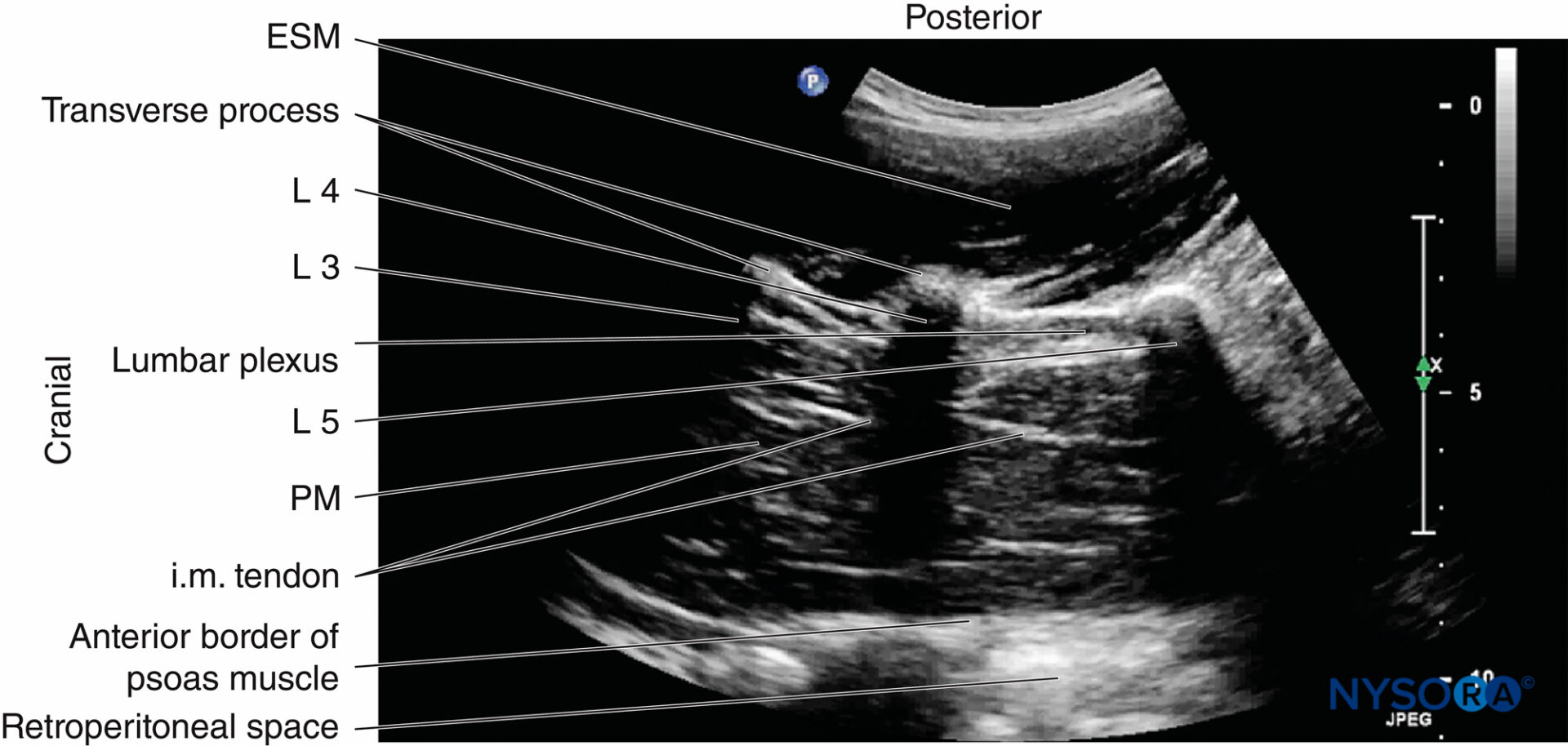 Regional Anesthesia Sagittal Sonogram Of The Lumbar Paravertebral