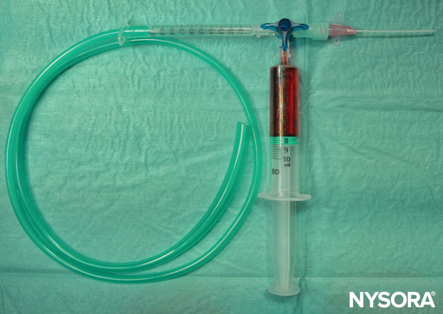 Regional and Topical Anesthesia for Awake Endotracheal Intubation - NYSORA