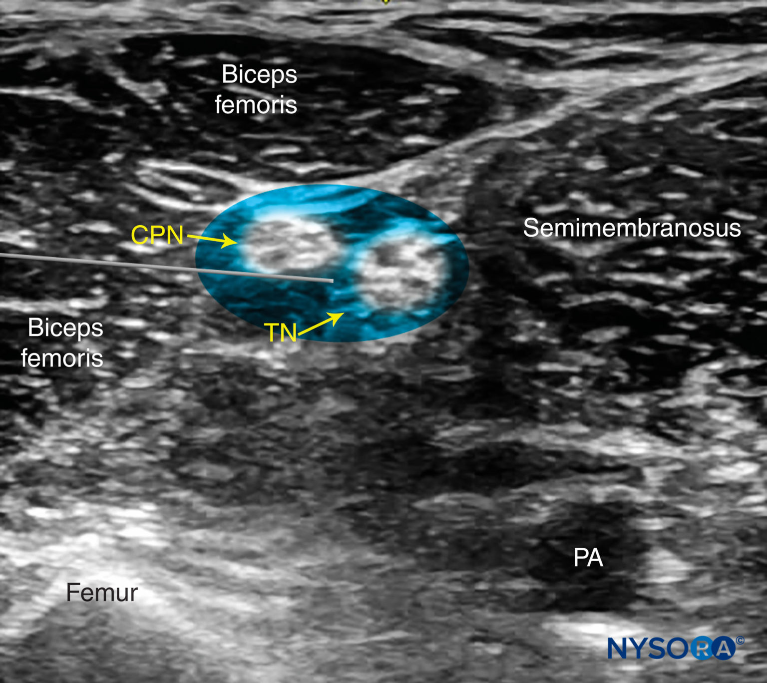 Ultrasound-Guided Popliteal Sciatic Nerve Block - NYSORA