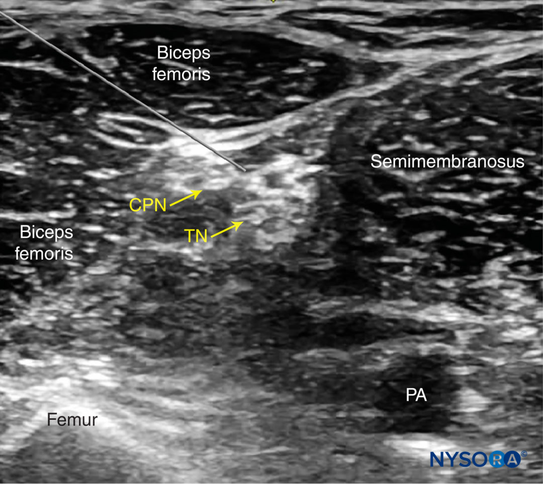 Ultrasound-Guided Popliteal Sciatic Nerve Block - NYSORA