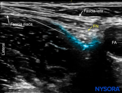 Ultrasound-Guided Femoral Nerve Block - NYSORA