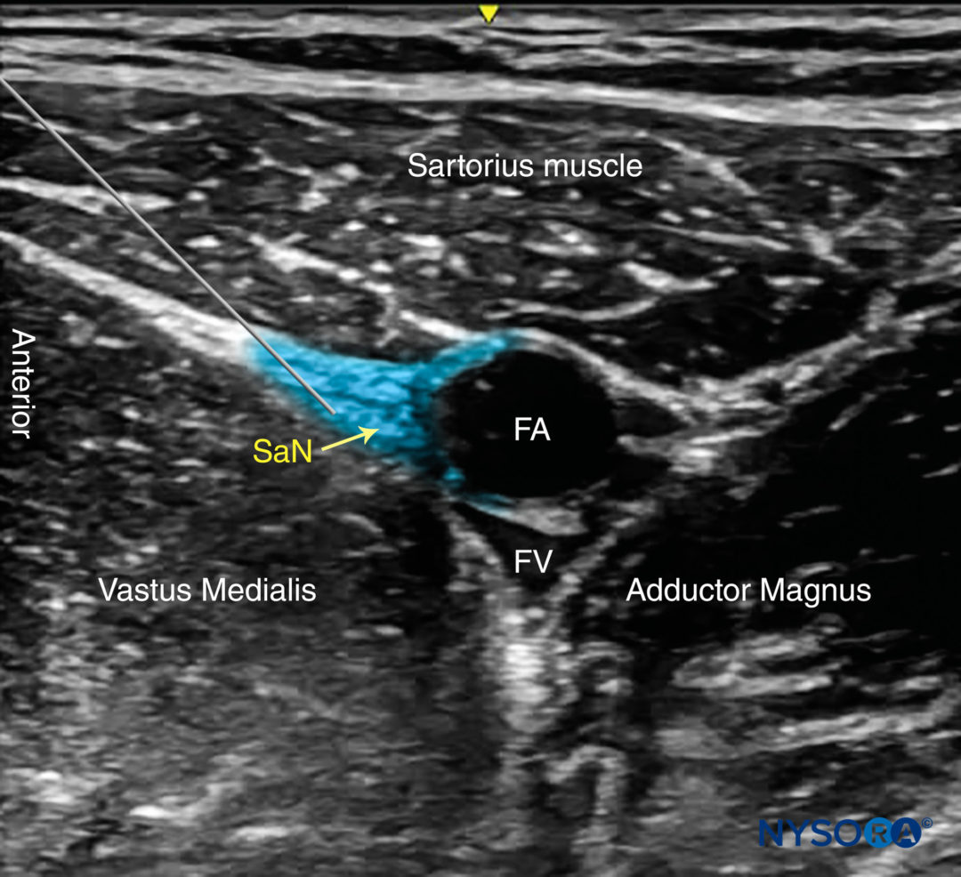 Ultrasound-Guided Saphenous (Adductor Canal) Nerve Block - NYSORA
