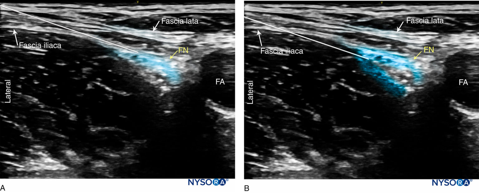 Ultrasound-Guided Femoral Nerve Block - NYSORA