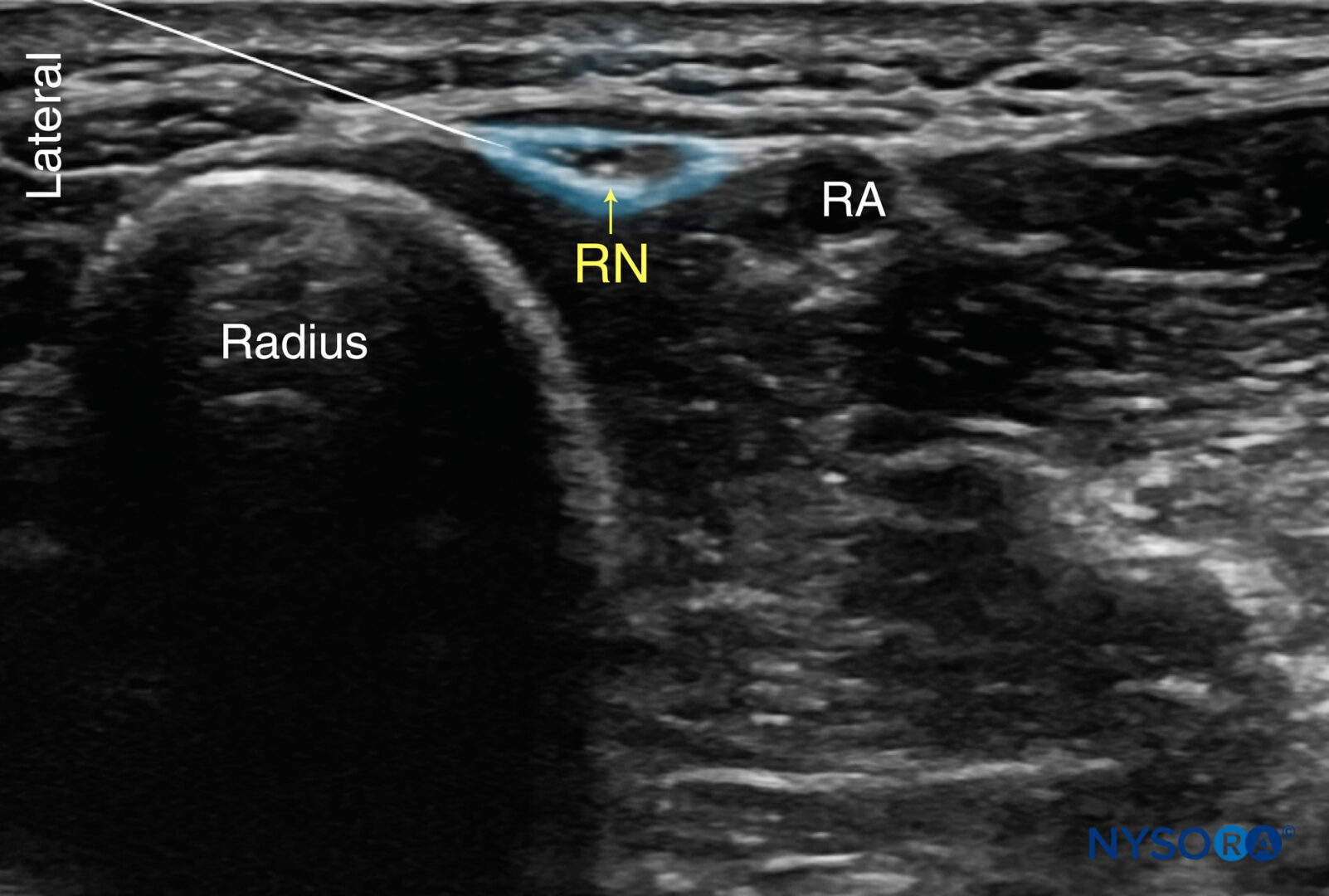 Ultrasound-Guided Wrist Nerve Block - NYSORA