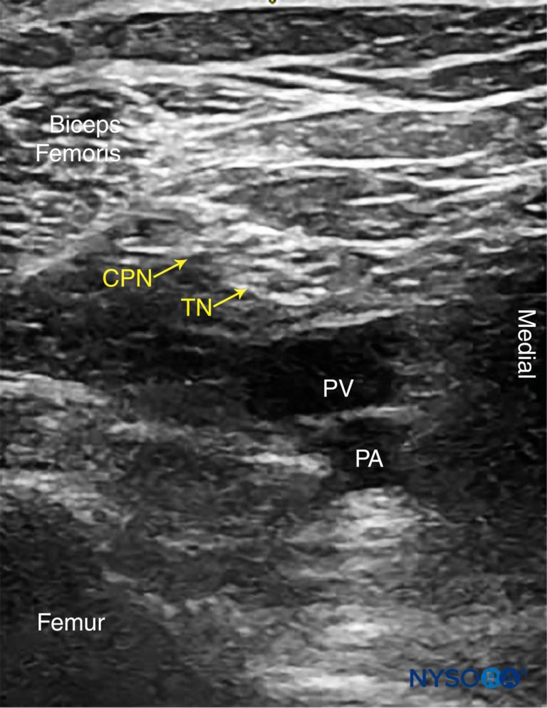 Ultrasound-Guided Popliteal Sciatic Nerve Block - NYSORA