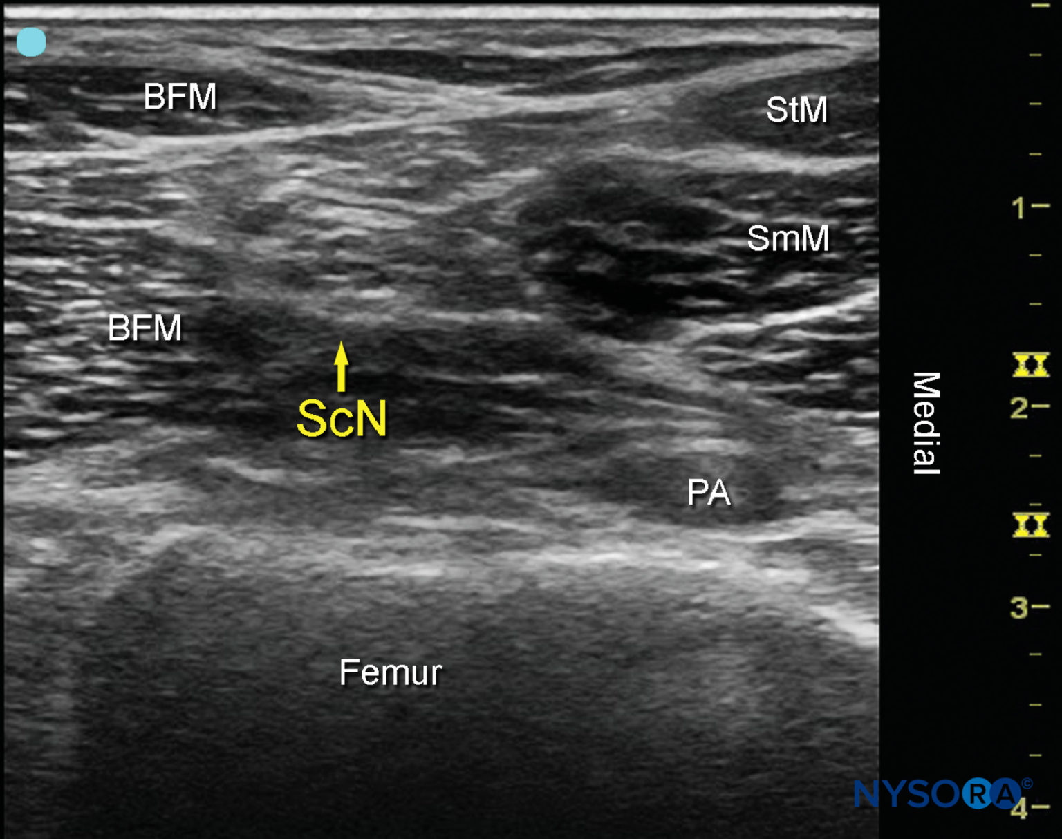 Ultrasound-Guided Popliteal Sciatic Nerve Block - NYSORA