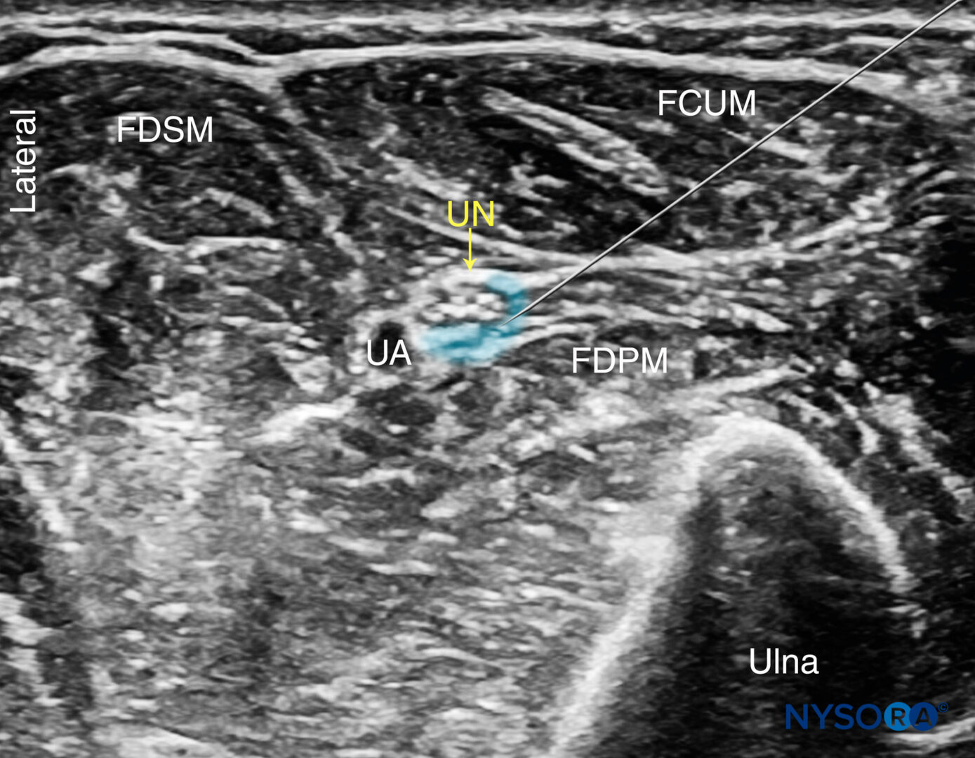 Ultrasound-Guided Wrist Nerve Block - NYSORA