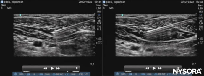 Pectoralis and Serratus Plane Nerve Blocks - NYSORA