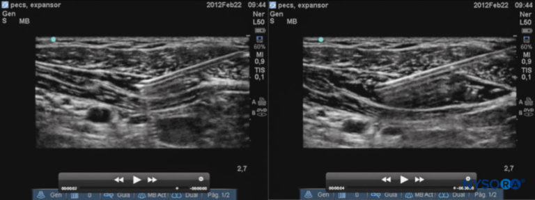 Pectoralis and Serratus Plane Nerve Blocks - NYSORA