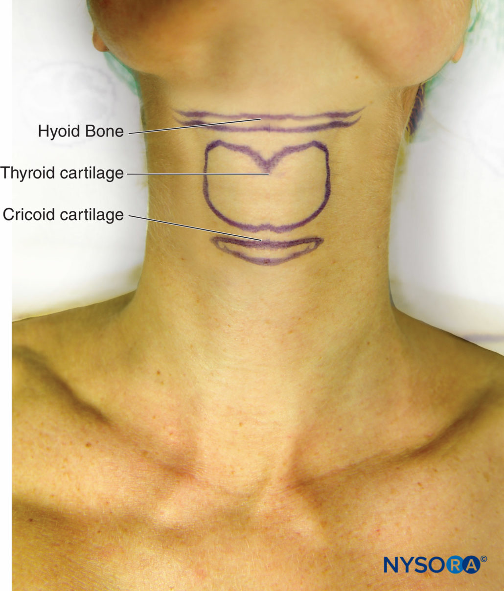 Hyoid Bone Anatomy Function And Common Issues - vrogue.co Hyoid Bone Anatomy Function And Common Issues - vrogue.co