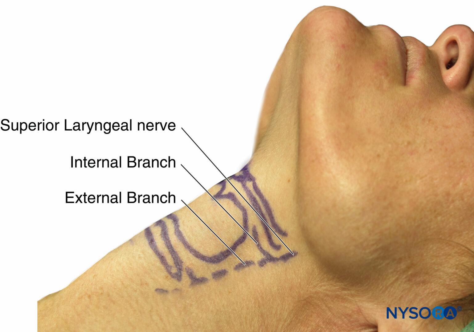 Superior Laryngeal Nerve Block