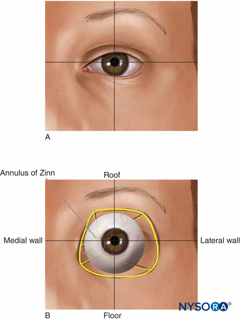 Local and Regional Anesthesia for Ophthalmic Surgery - NYSORA