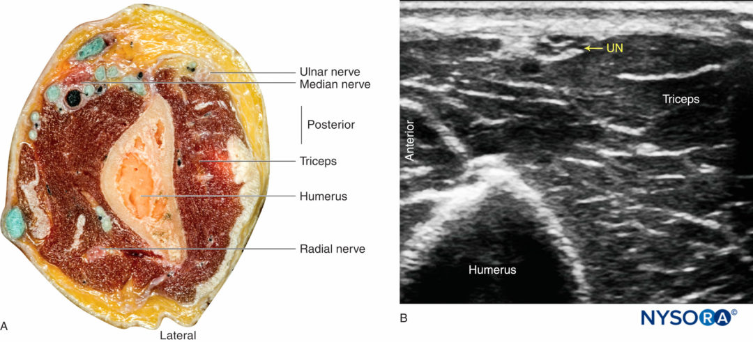 Ultrasound-Guided Blocks at the Elbow - NYSORA