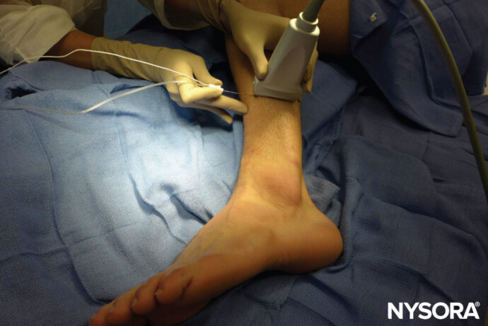 Ultrasound-Guided Ankle Nerve Block