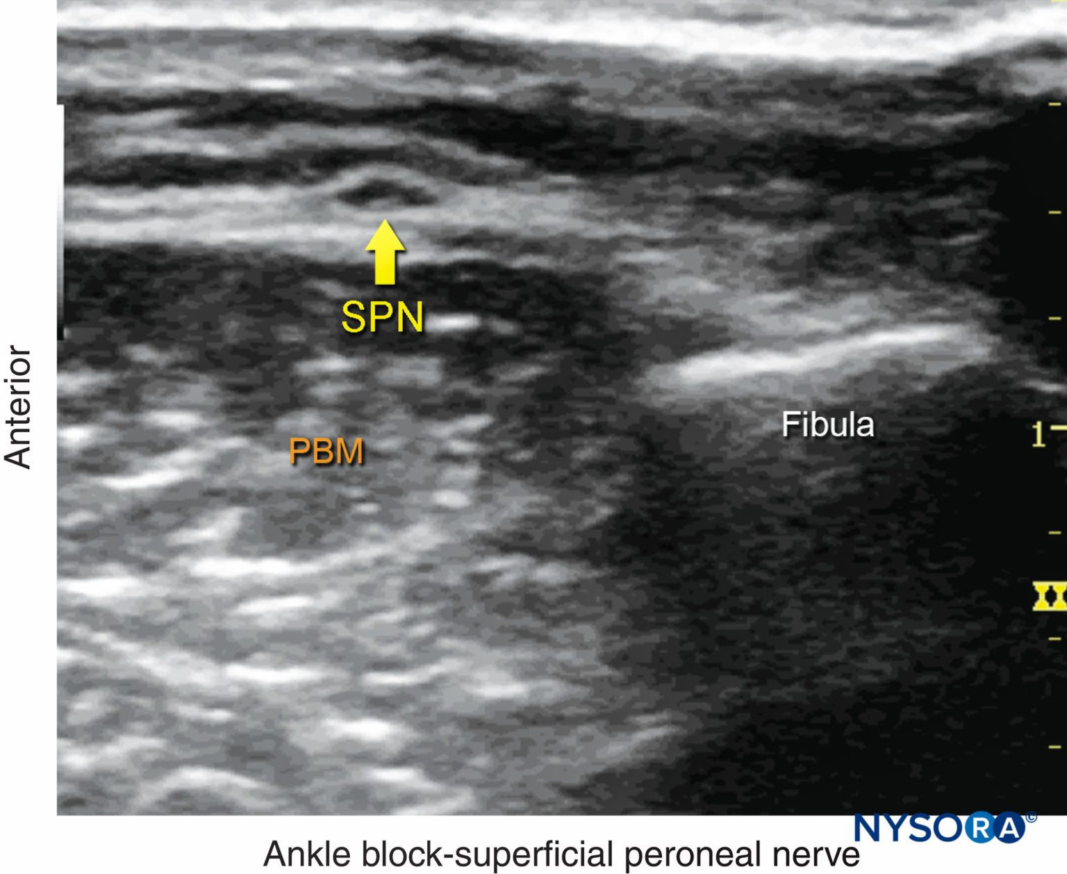 Ultrasound-Guided Ankle Nerve Block