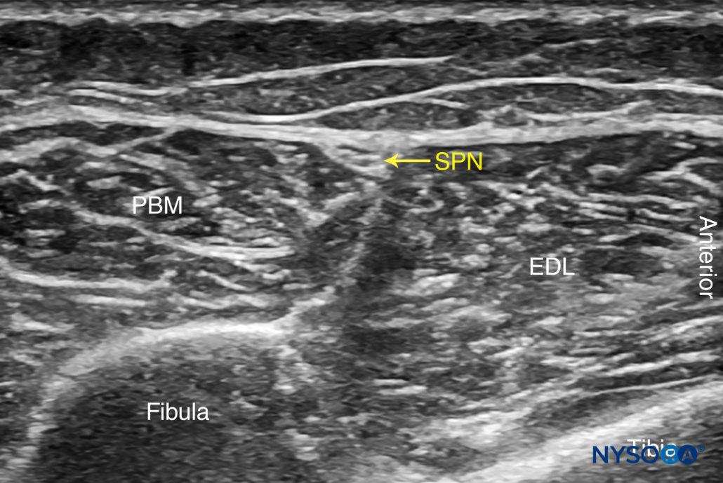 Ultrasound-Guided Ankle Nerve Block