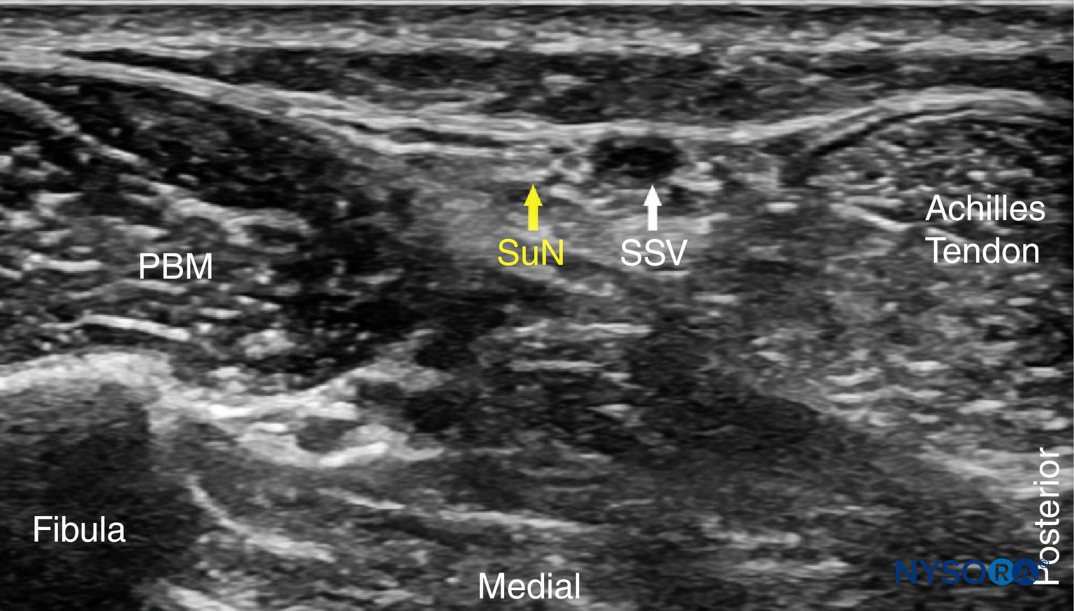 regional-anesthesia-ultrasound-anatomy-of-the-sural-nerve - NYSORA