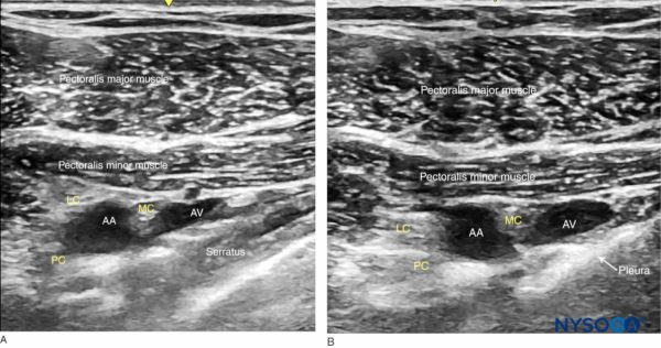Ultrasound-Guided Infraclavicular Brachial Plexus Nerve Block - NYSORA