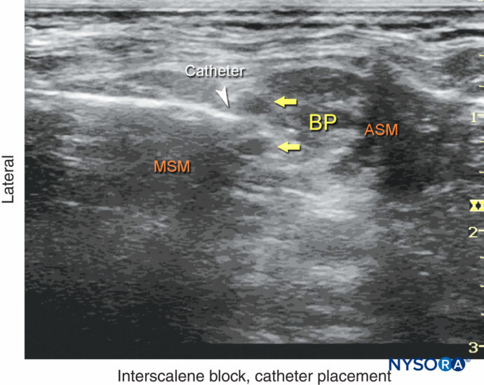 Shoulder Surgery - NYSORA