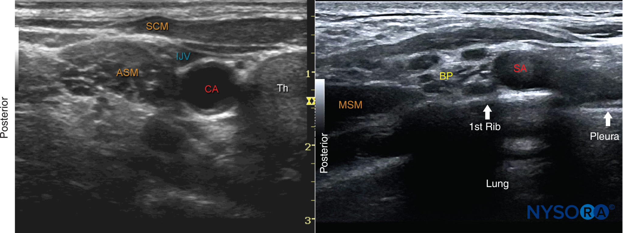 Ultrasound-Guided Interscalene Brachial Plexus Nerve Block - NYSORA