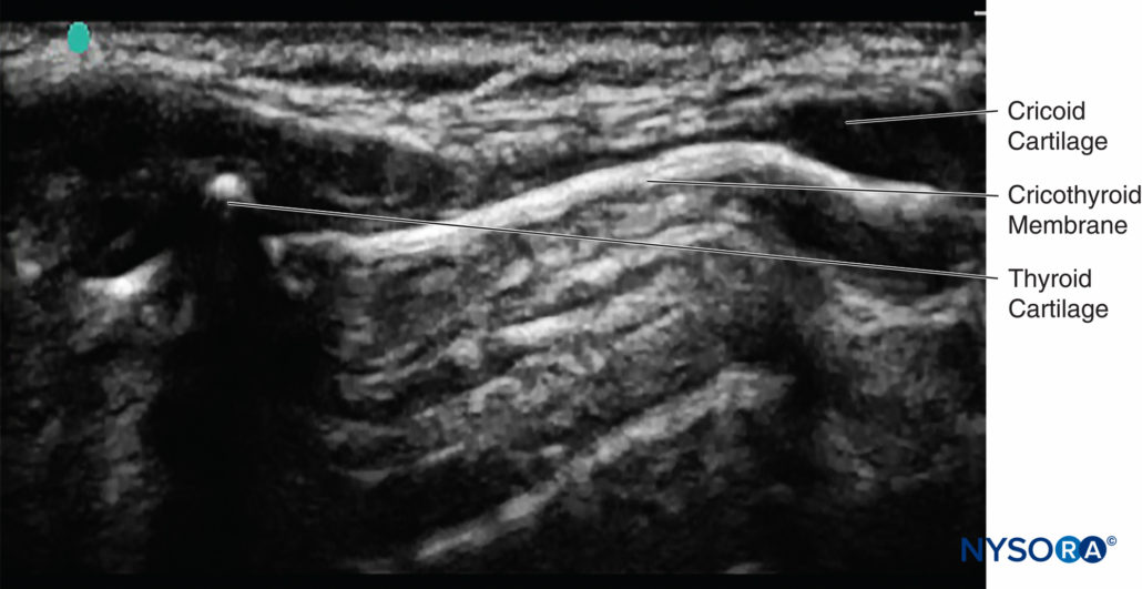 regional-anesthesia-ultrasound-image-of-cricoid-cartilage-thyroid ...