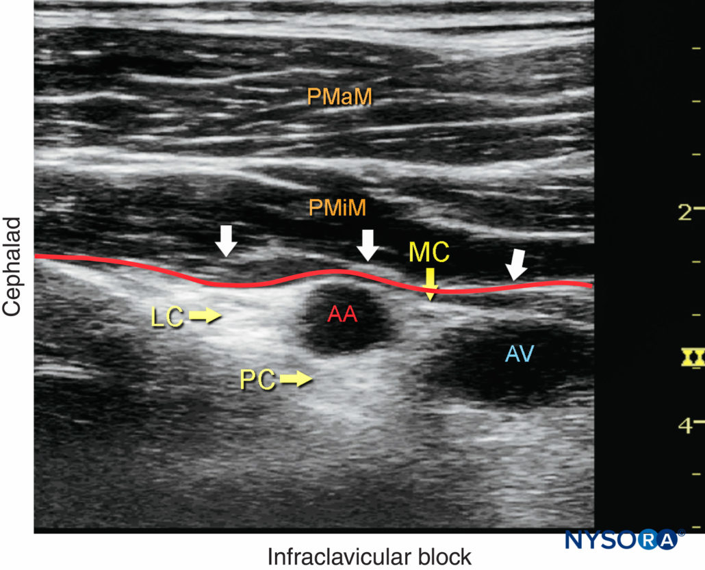 Ultrasound-Guided Infraclavicular Brachial Plexus Nerve Block - NYSORA