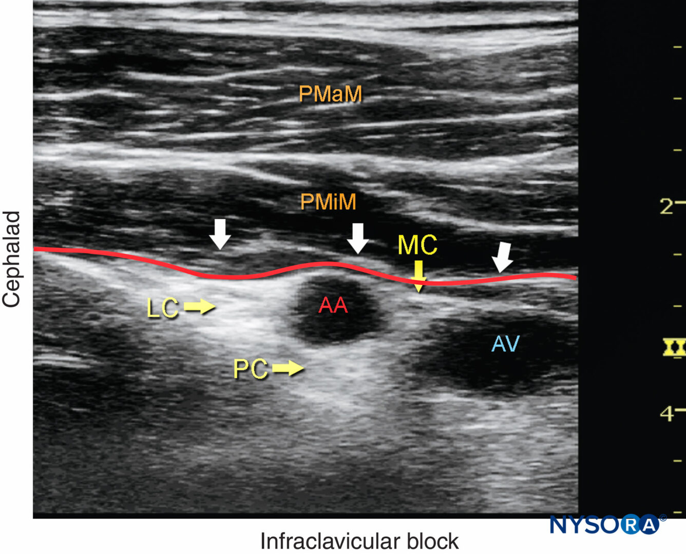 Ultrasound-Guided Infraclavicular Brachial Plexus Nerve Block - NYSORA