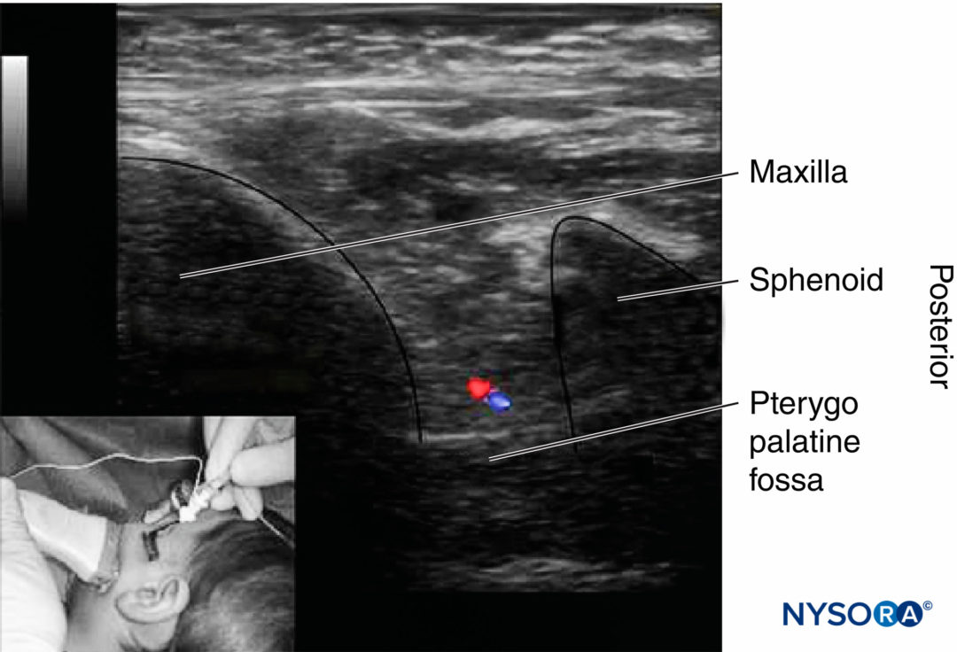 Nervenblockaden im Gesicht - NYSORA
